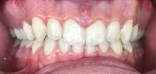 Aligners: The Solution for Spaced Teeth | BASMA