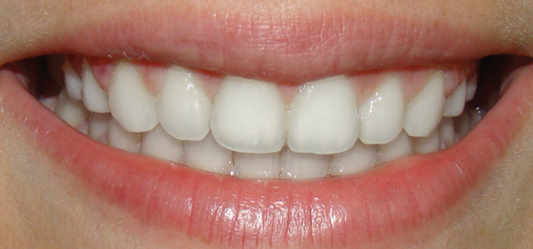 How Crowded Teeth May Affect Your Oral Health | BASMA