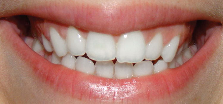 How Crowded Teeth May Affect Your Oral Health | BASMA
