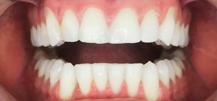 How Crowded Teeth May Affect Your Oral Health | BASMA